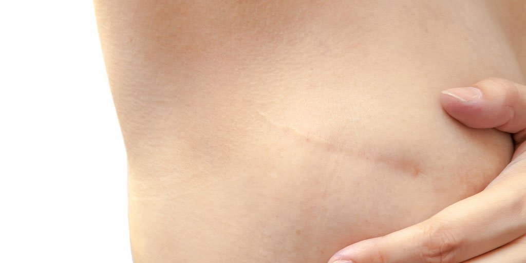 Stitches Scars: Causes & Treatments | La Roche-Posay