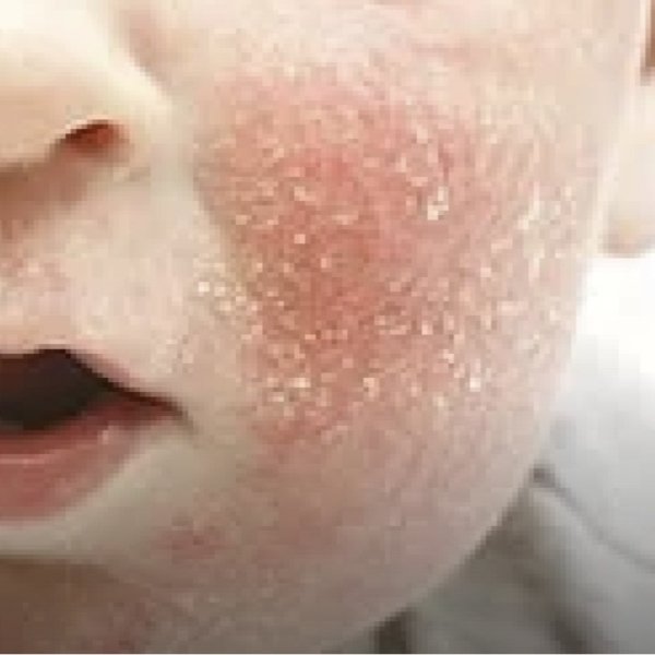 Kids with Eczema: A Parent s Guide | La Roche-Posay